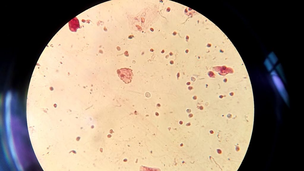 Colpitis: a disease that requires attention