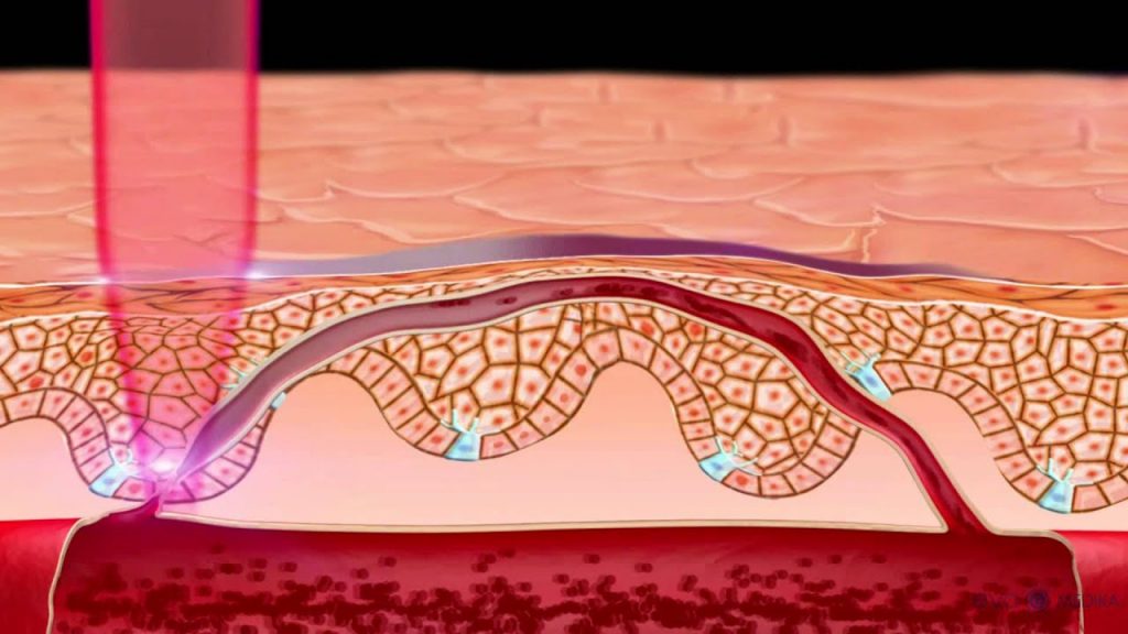 Methods for removing neoplasms on the skin